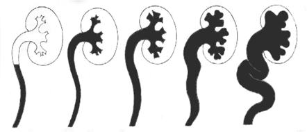 Vesicoureteral Reflux