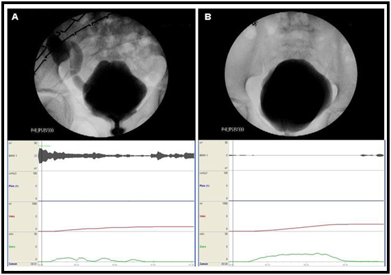 Urinary Incontinence and Biofeedback